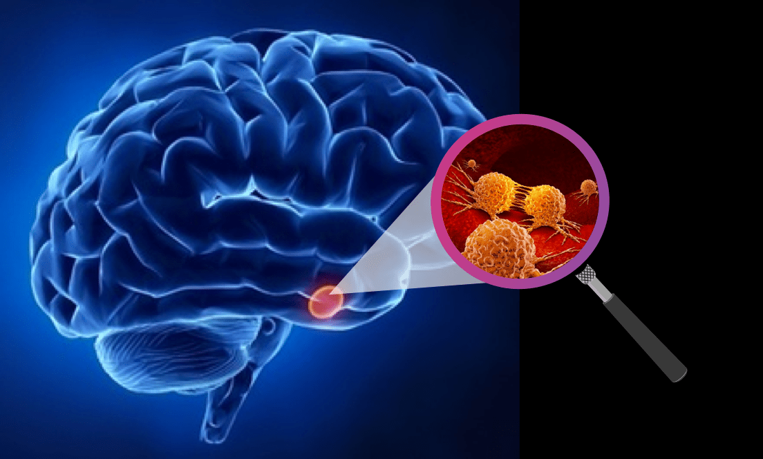 Brain Tumour Types & Their Warning Signs